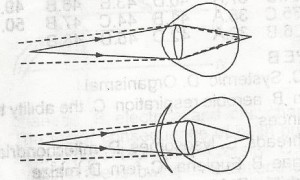 In the diagram, the eye defect illustrated is | Campusflava
